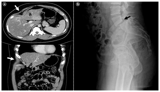 18p Deletion Syndrome Originating from Rare Unbalanced Whole-Arm ...