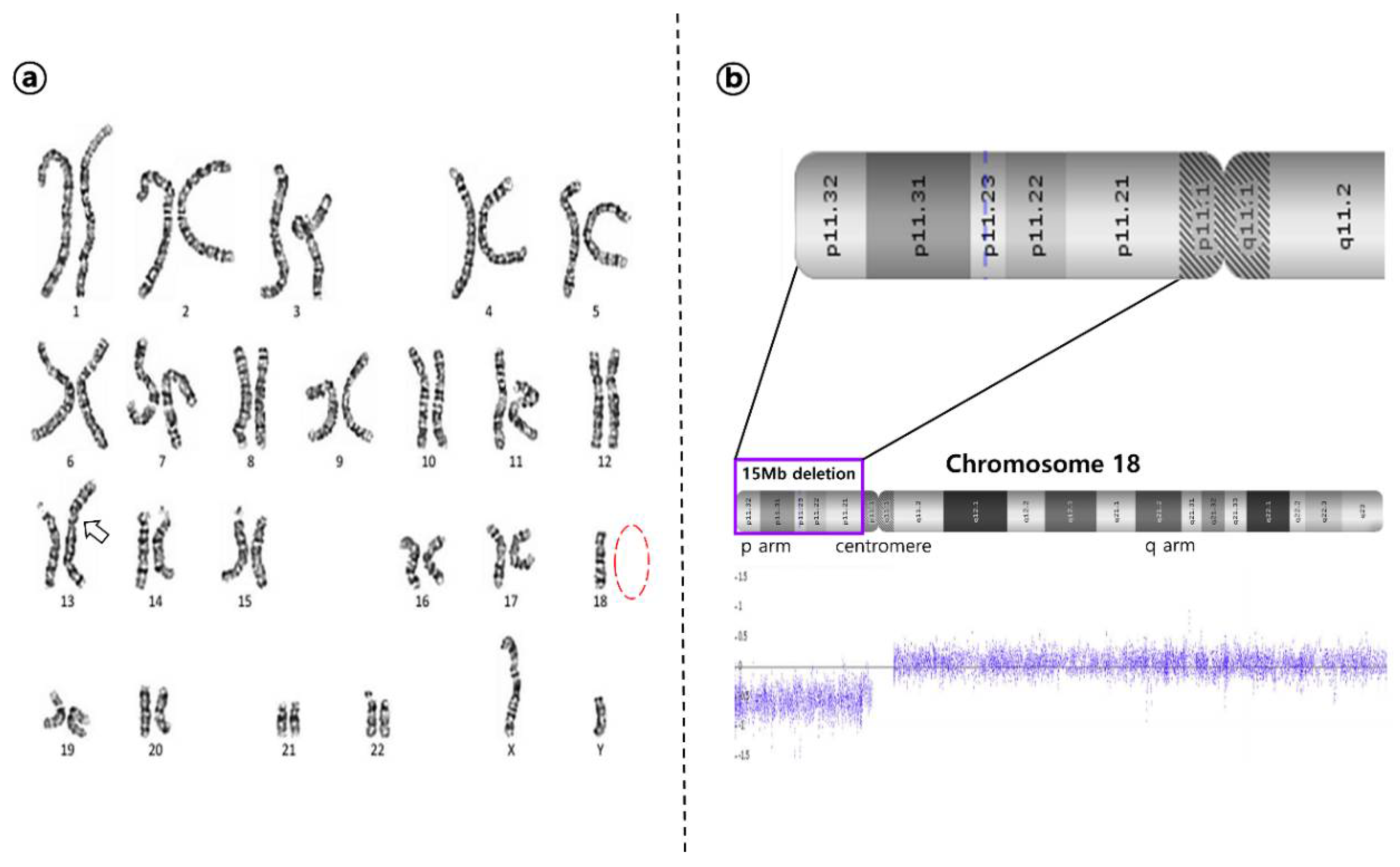 18p Deletion Syndrome Originating from Rare Unbalanced Whole-Arm ...