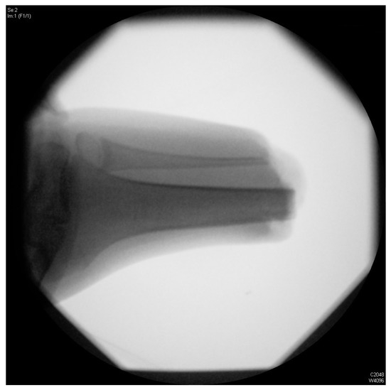 Lower-Limb Amputation in Children and Adolescents—A Rare Encounter with ...