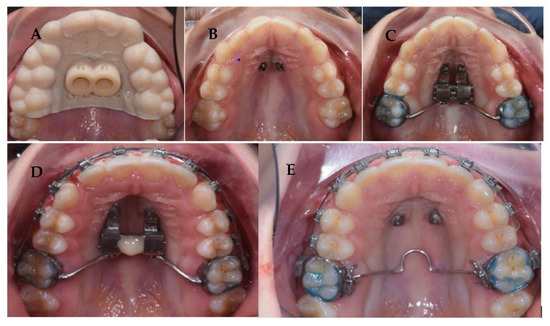 Rapid Maxillary Expansion on the Adolescent Patient: Systematic Review ...