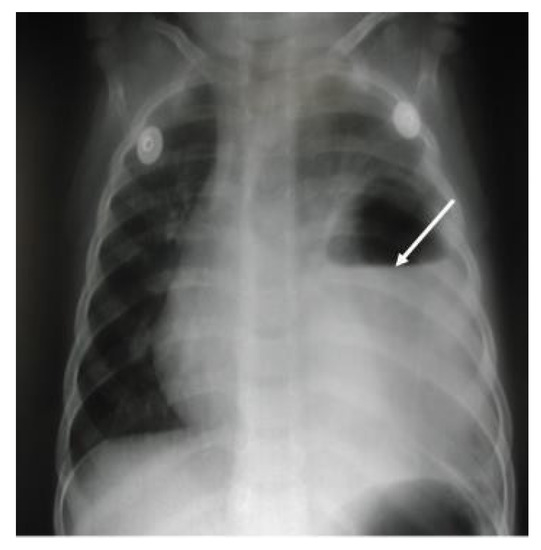 Lung Abscess Case Series and Review of the Literature