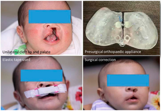 The Perception and Experience of Parents of Children with Cleft Lip and ...