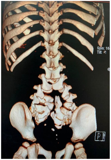 Split Notochord Syndrome with Spinal Column Duplication and Spinal Cord ...