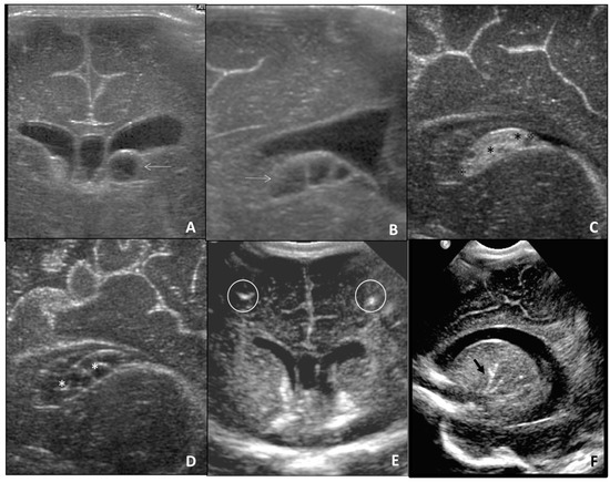 From Fetal to Neonatal Neuroimaging in TORCH Infections: A Pictorial Review