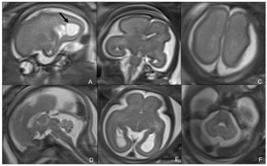 From Fetal to Neonatal Neuroimaging in TORCH Infections: A Pictorial Review