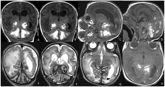 From Fetal to Neonatal Neuroimaging in TORCH Infections: A Pictorial Review