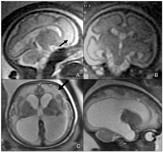 From Fetal to Neonatal Neuroimaging in TORCH Infections: A Pictorial Review
