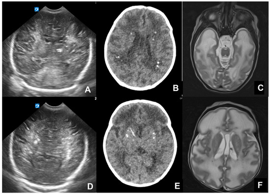 From Fetal to Neonatal Neuroimaging in TORCH Infections: A Pictorial Review