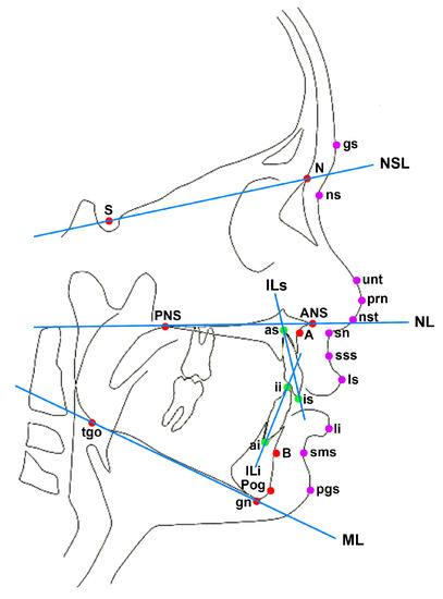Craniofacial Growth at Age 6–11 Years after One-Stage Cleft Lip and ...