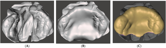 A Point-of-Care Digital Workflow for 3D Printed Passive Presurgical ...