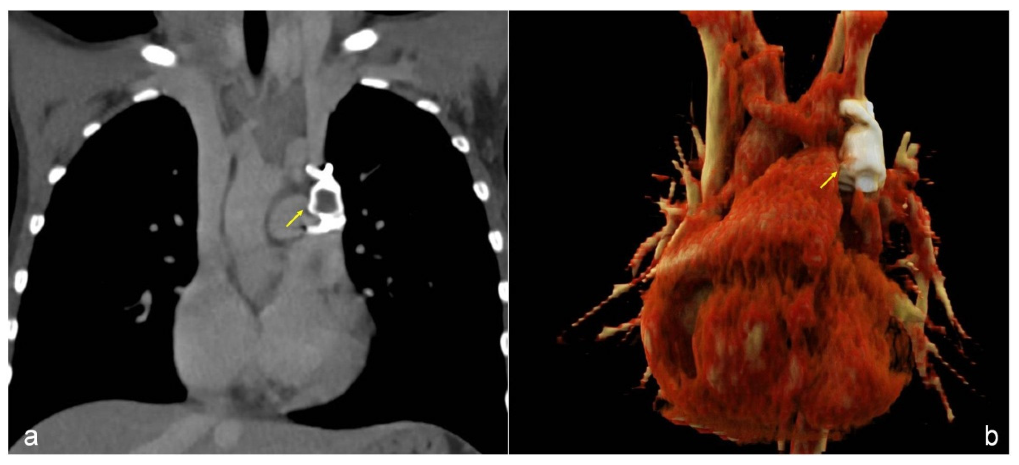Unexplained Hypoxemia in School-Age Child: Do Not Forget the Double ...