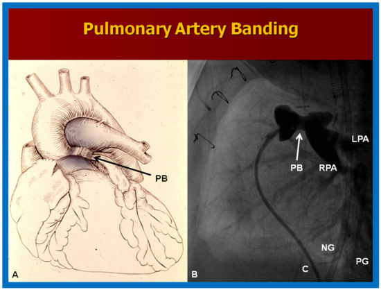 Double-Inlet Left Ventricle