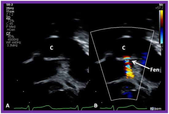 Double-Inlet Left Ventricle