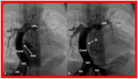 Children | Free Full-Text | Double-Inlet Left Ventricle