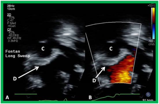 Double-Inlet Left Ventricle