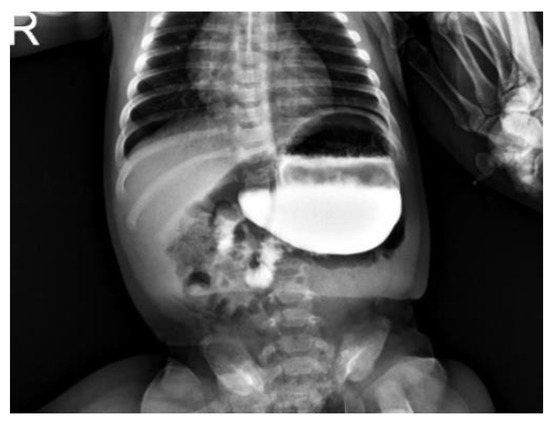 Laparoscopic Assisted Percutaneous Anterior Gastropexy for the ...