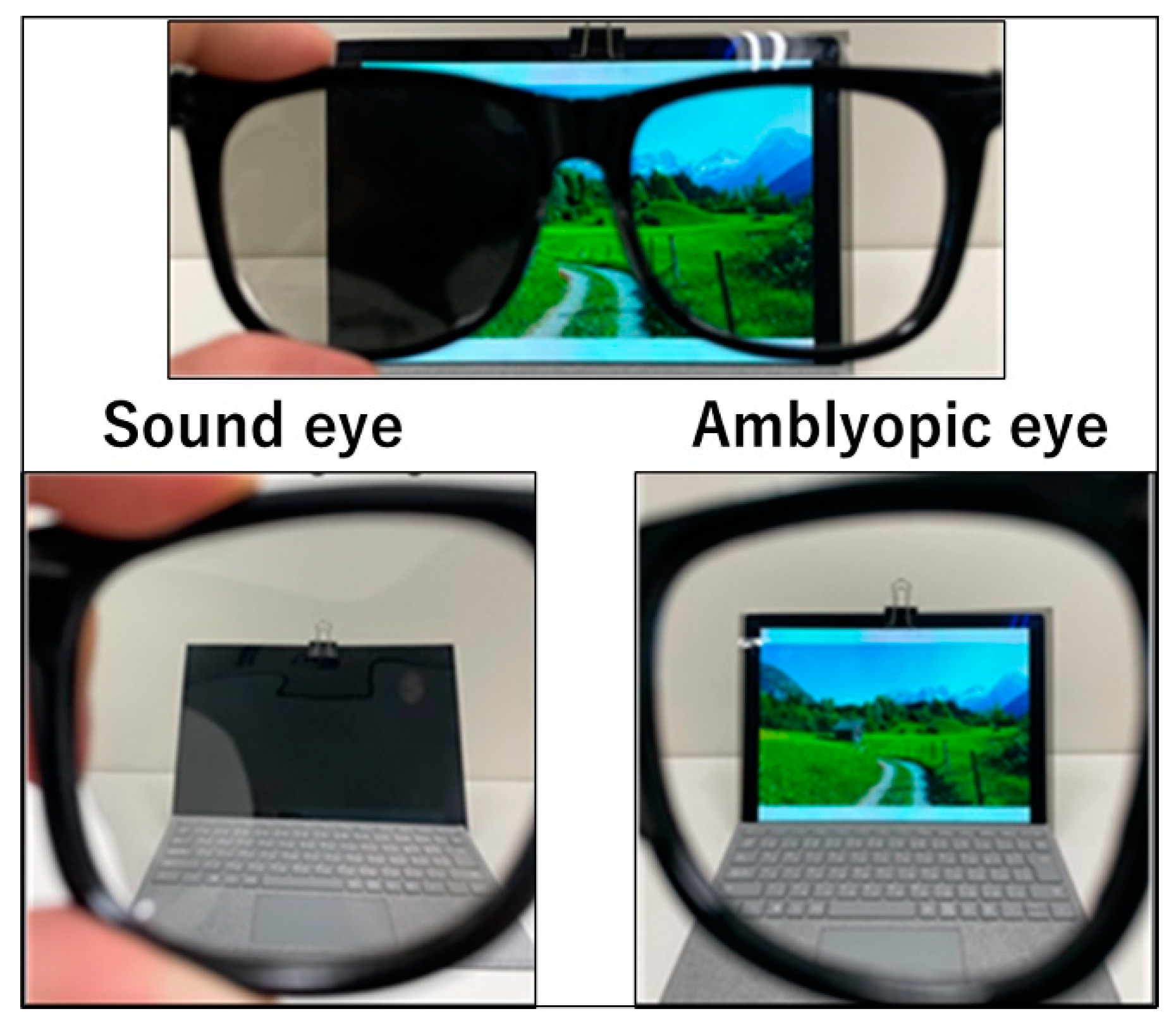 Comparison of Amblyopia Treatment Effect with Dichoptic Method Using Polarizing Film and ...