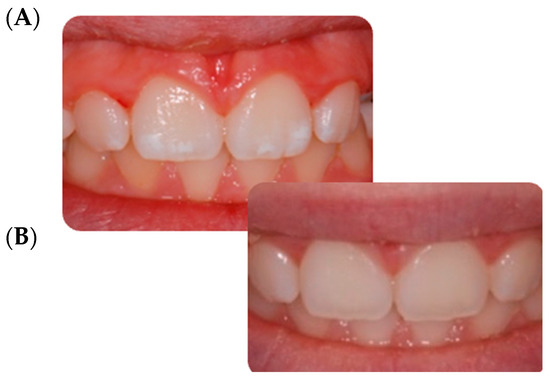 Management of Enamel Defects with Resin Infiltration Techniques: Two ...