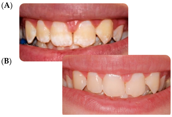 Management of Enamel Defects with Resin Infiltration Techniques: Two ...