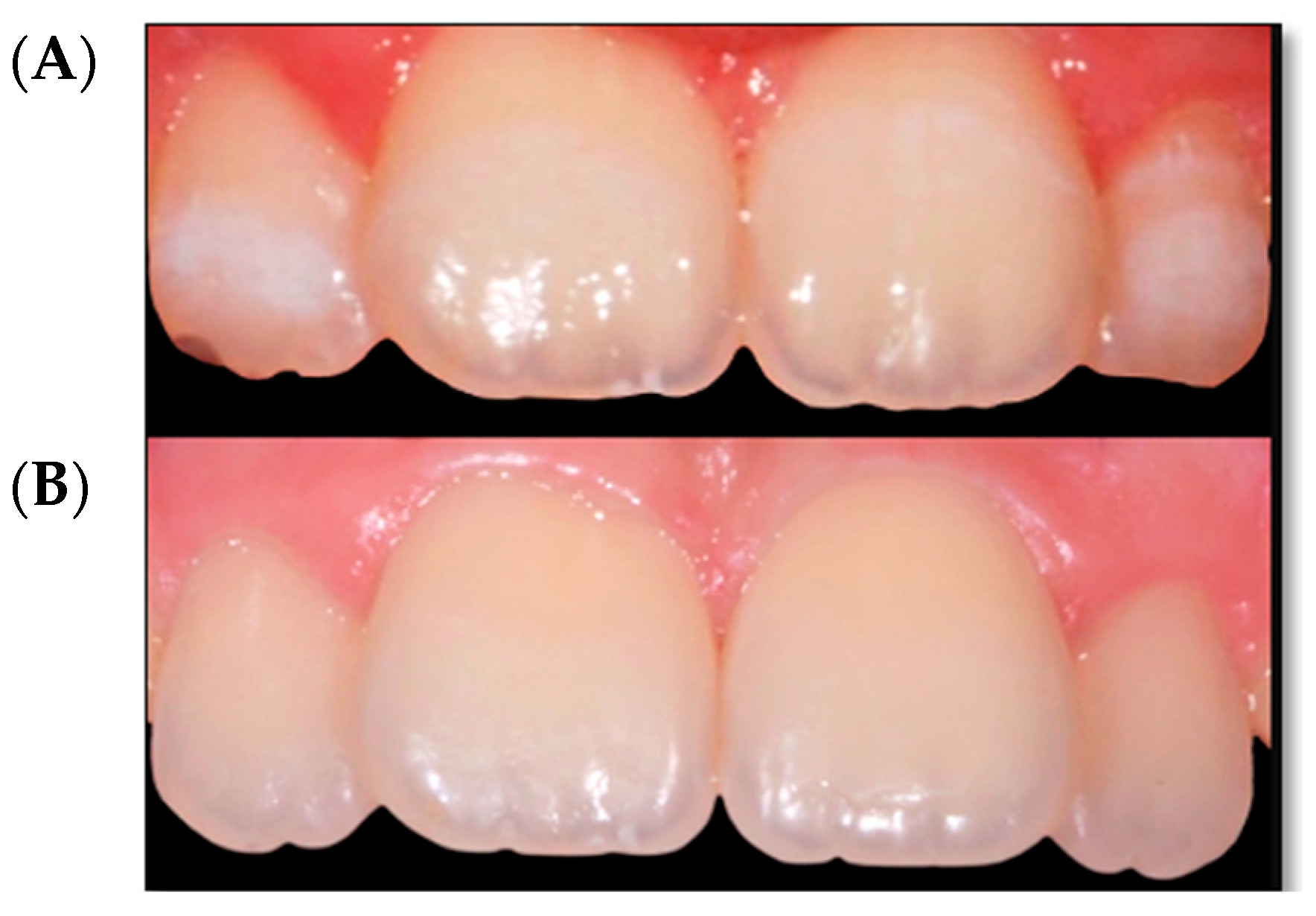 Management of Enamel Defects with Resin Infiltration Techniques: Two ...