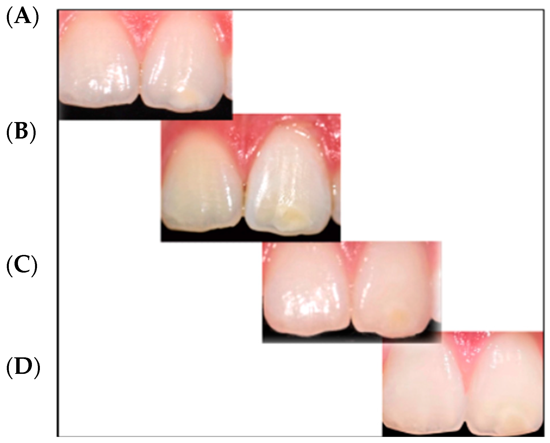 Management of Enamel Defects with Resin Infiltration Techniques: Two ...