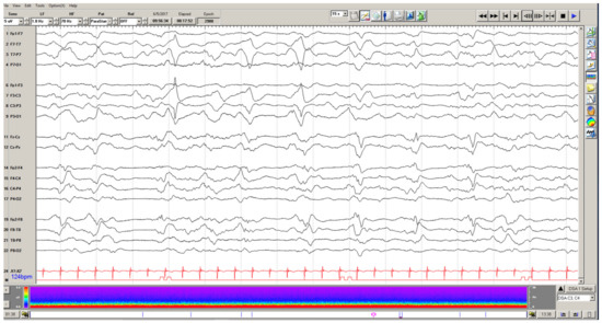 Children | Free Full-Text | The Role of Electroencephalography in the ...