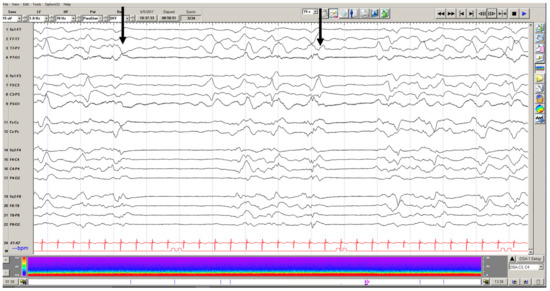Children | Free Full-Text | The Role of Electroencephalography in the ...