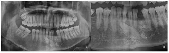 Characteristics, Diagnosis and Treatment of Compound Odontoma ...
