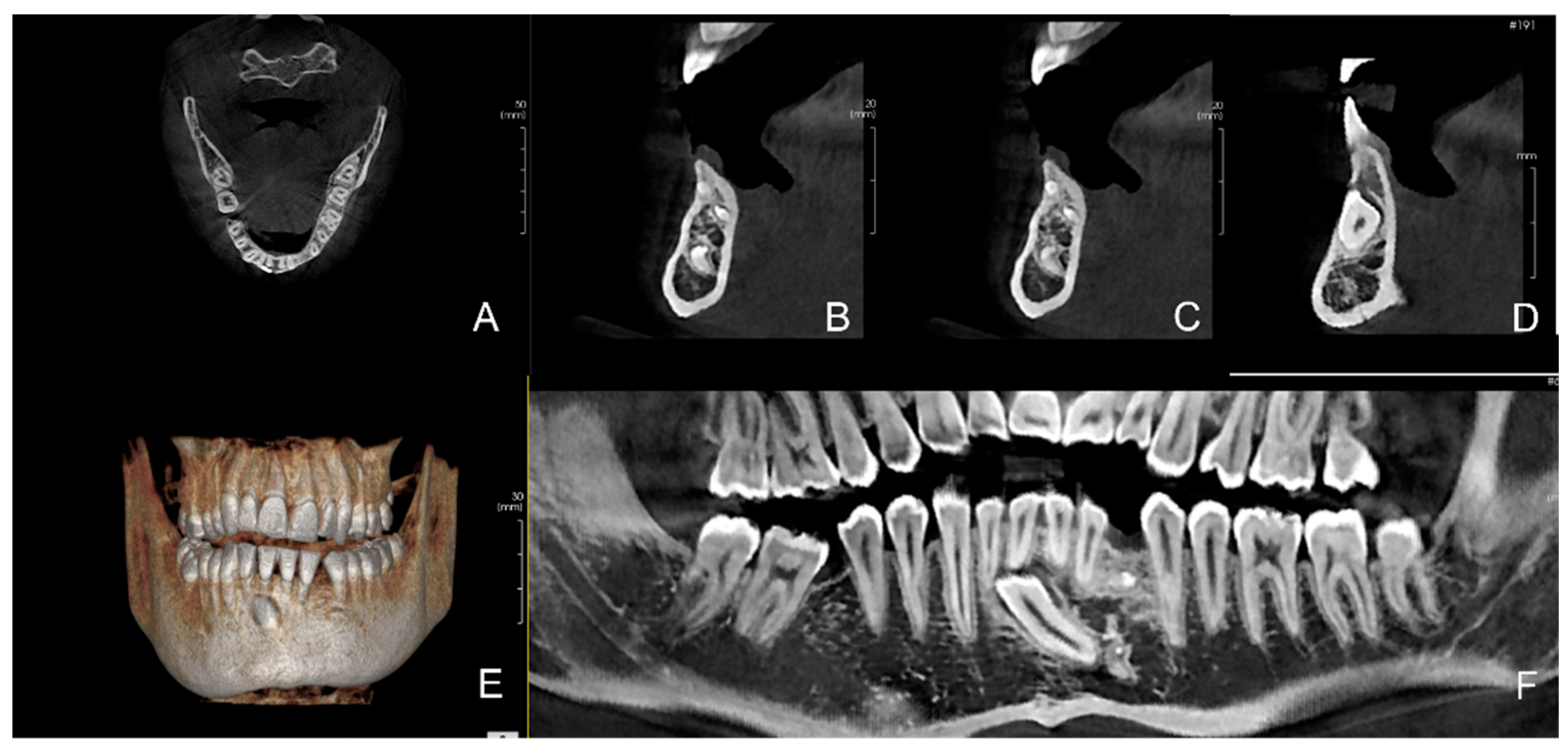 Characteristics, Diagnosis and Treatment of Compound Odontoma Associated with Impacted Teeth