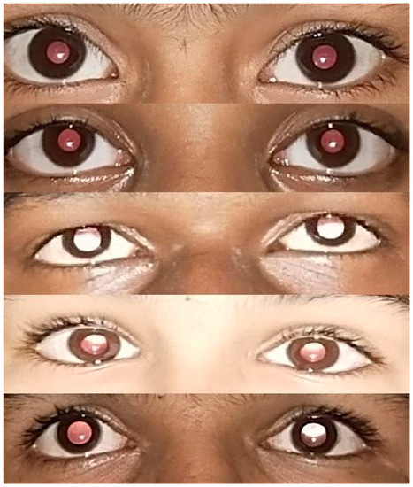 Reliability of Smart Phone Photographs for School Eye Screening