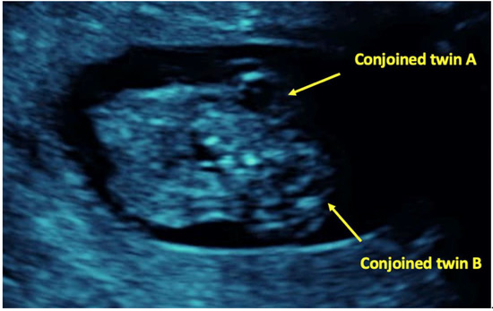 Unique Case Of Conjoined Triplets