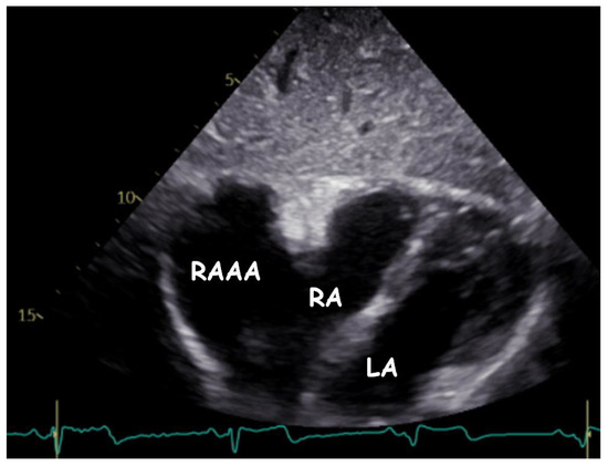 A Gigantic Congenital Right Atrial Appendage Aneurysm in an Infant: Ten ...