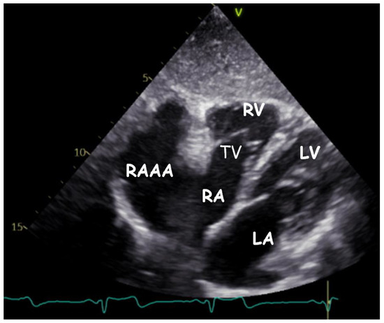 A Gigantic Congenital Right Atrial Appendage Aneurysm in an Infant: Ten ...