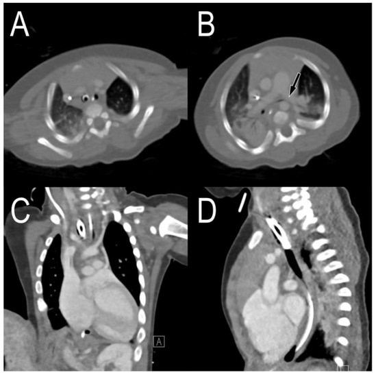 Prevention of Tracheo-Innominate Artery Fistula Formation as a ...