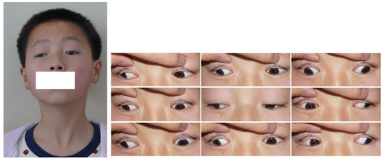 Congenital Fibrosis of the Extraocular Muscles: An Overview from ...