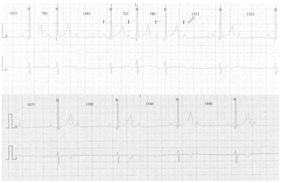 Atrioventricular Block in Celiac Disease: An Unusual Clinical ...