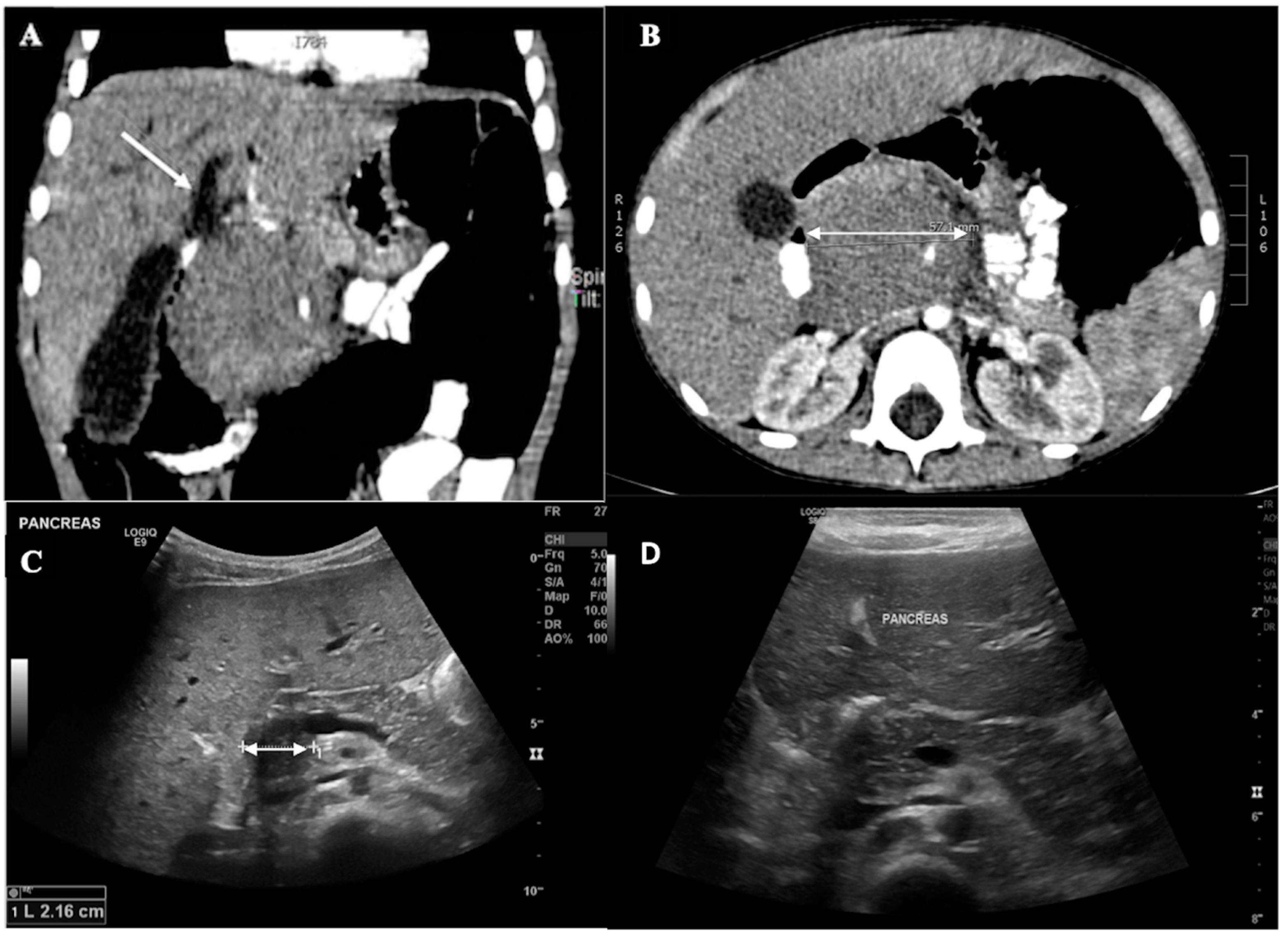 Successful Treatment of Pediatric Acute Myeloid Leukemia Presenting ...