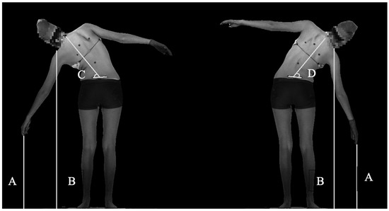 3D Surface Topographic Optical Scans Yield Highly Reliable Global Spine ...