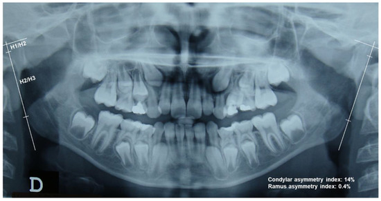 Condylar Asymmetry in Children with Unilateral Posterior Crossbite ...