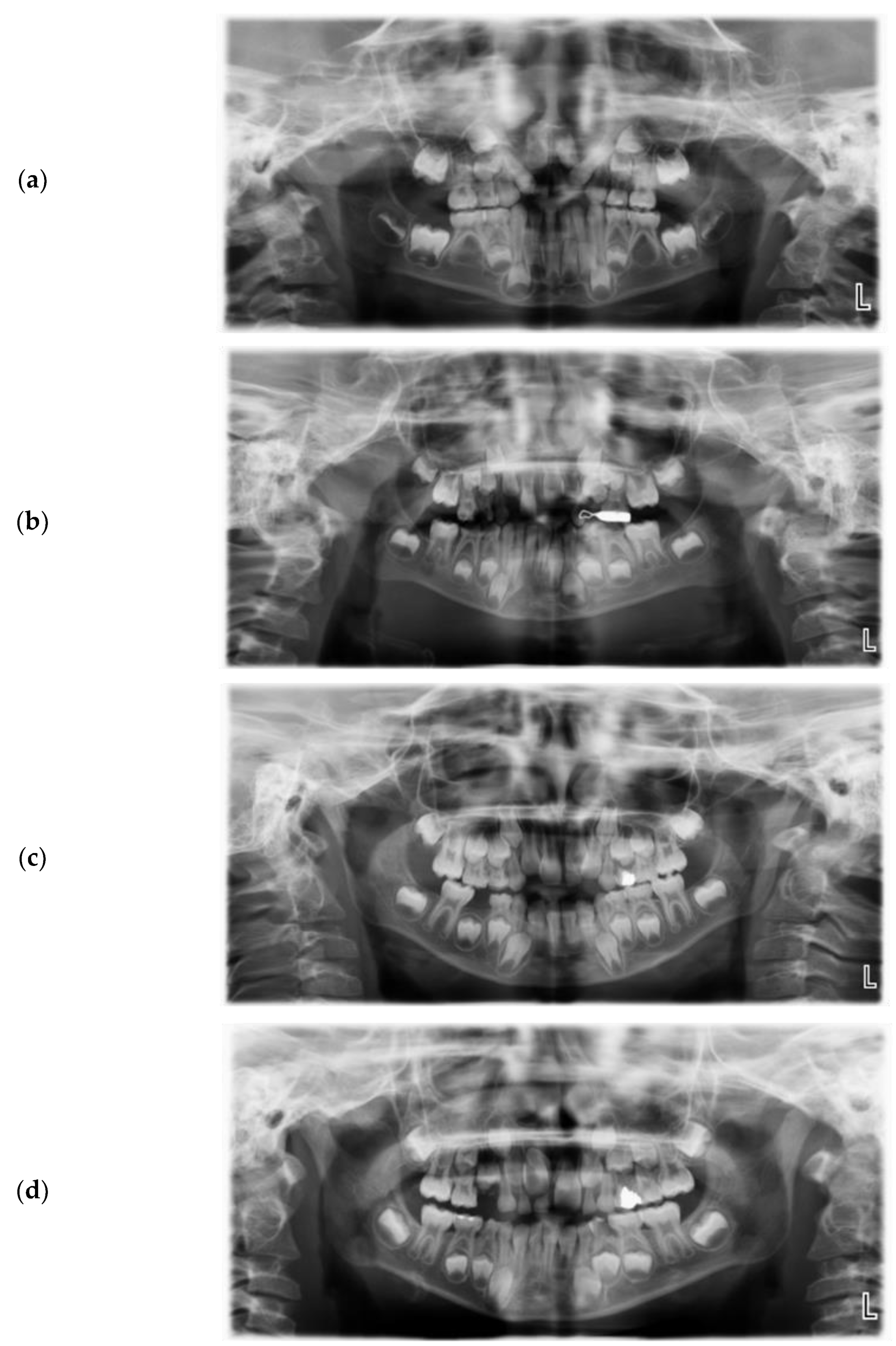 Prevalence of Delayed Eruption of Permanent Upper Central Incisors at a ...