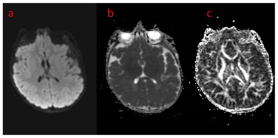 CDKL5 Deficiency Disorder (CDD)—Rare Presentation in Male