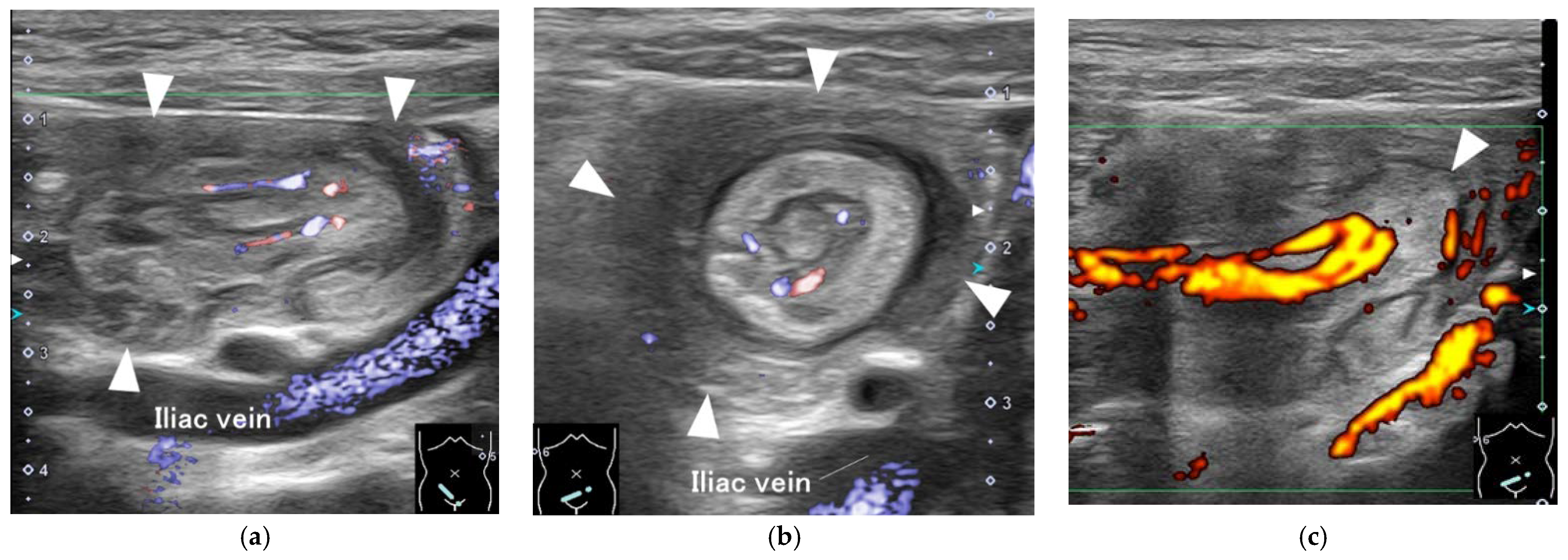 Meckel Diverticulum Ultrasound