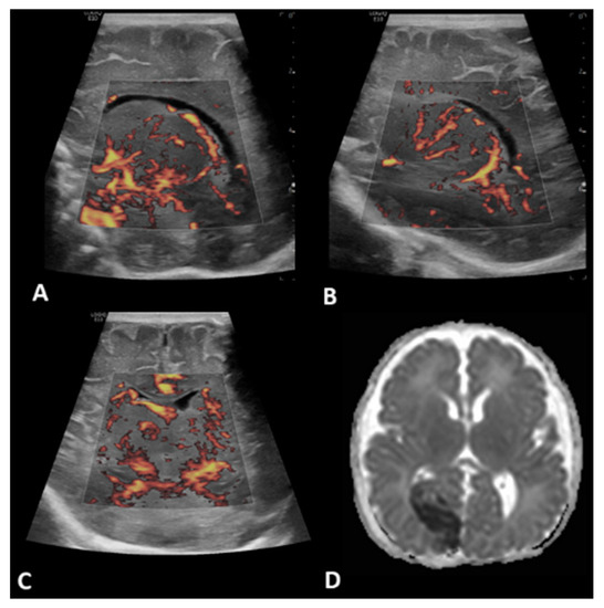 Utility of Cerebral Microvascular Imaging in Infants Undergoing ECMO