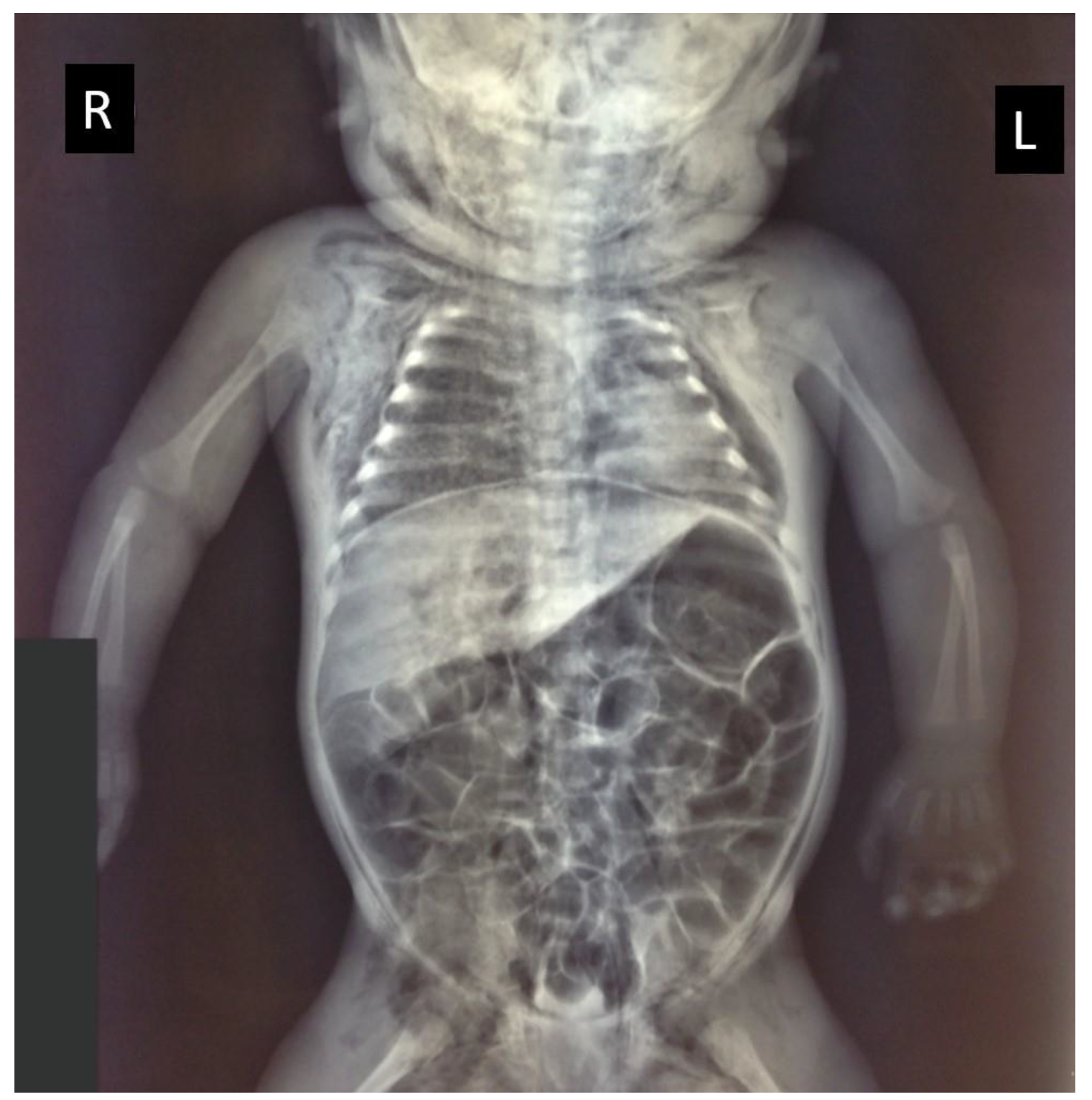 Congenital Cystic Adenomatoid Malformation (CCAM) Type II: A Rare Case ...
