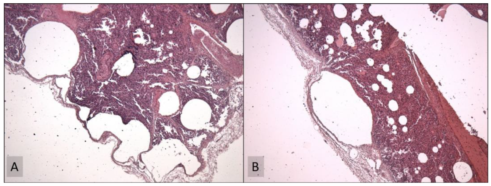 Congenital Cystic Adenomatoid Malformation (CCAM) Type II: A Rare Case ...