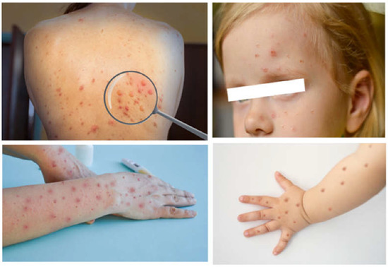Children | Free Full-Text | Monkeypox Infection 2022: An Updated ...