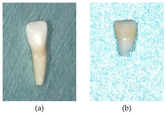 Different Dental Manifestations in Sisters with the Same ALPL Gene ...
