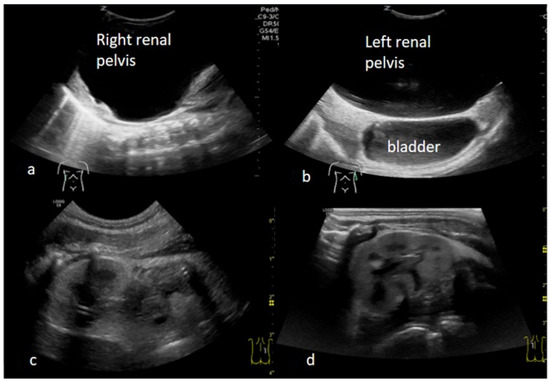 Giant Bilateral Hydronephrosis in A Newborn—A Case Report