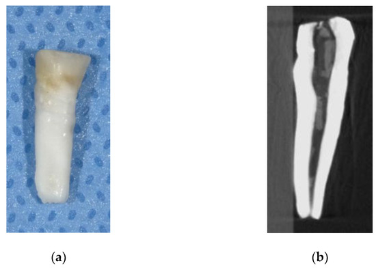 Osteomyelitis Possibly Caused by Exfoliation of Primary Teeth in a ...