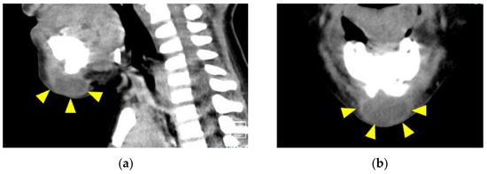 Osteomyelitis Possibly Caused by Exfoliation of Primary Teeth in a ...